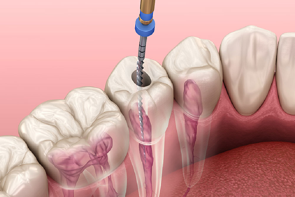 Perawatan Saluran Akar Gigi, Prosedur, Efek Samping, Biaya